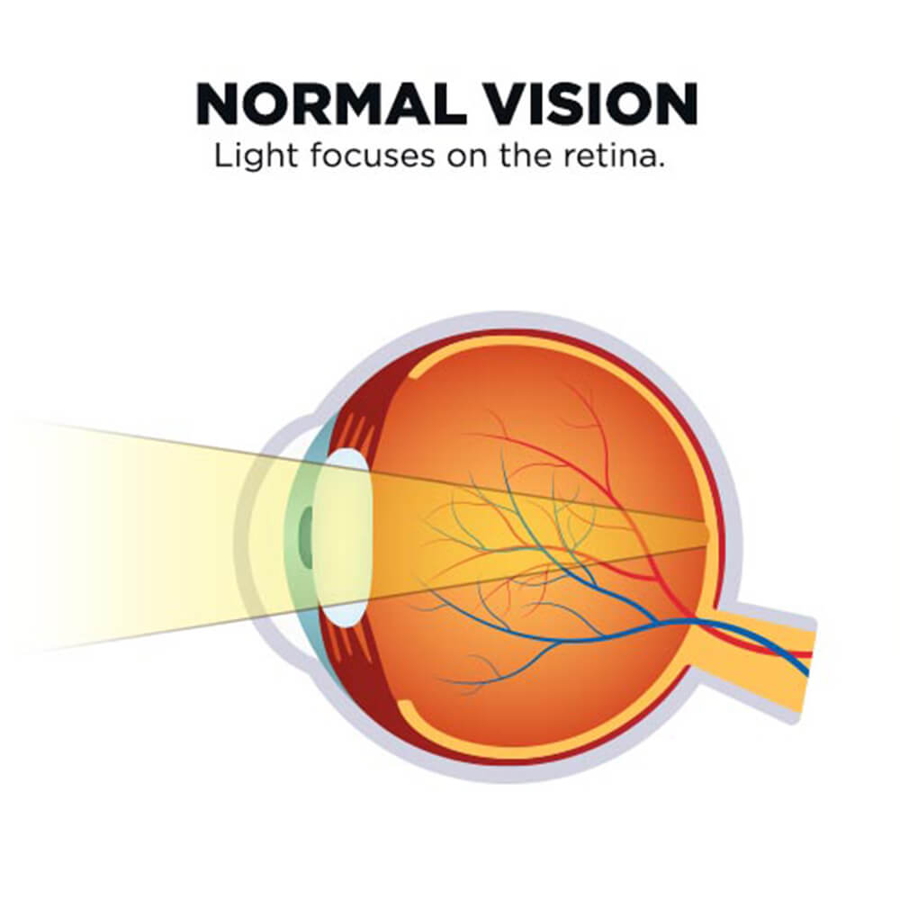 Top 5 Causes Of Blurred Vision Symptoms And Treatment Simvey top-5-causes-of-blurred-vision-symptoms-and-treatment-simvey