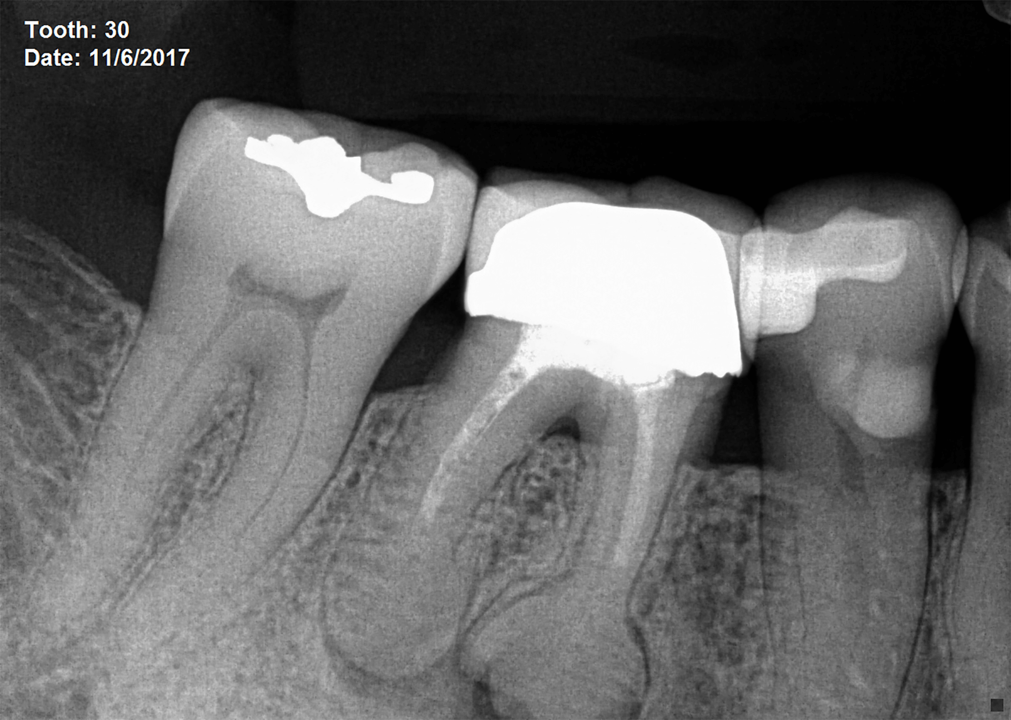 Endodontic Treatment with Hypercementosis - Case Studies - Pure Dental ...