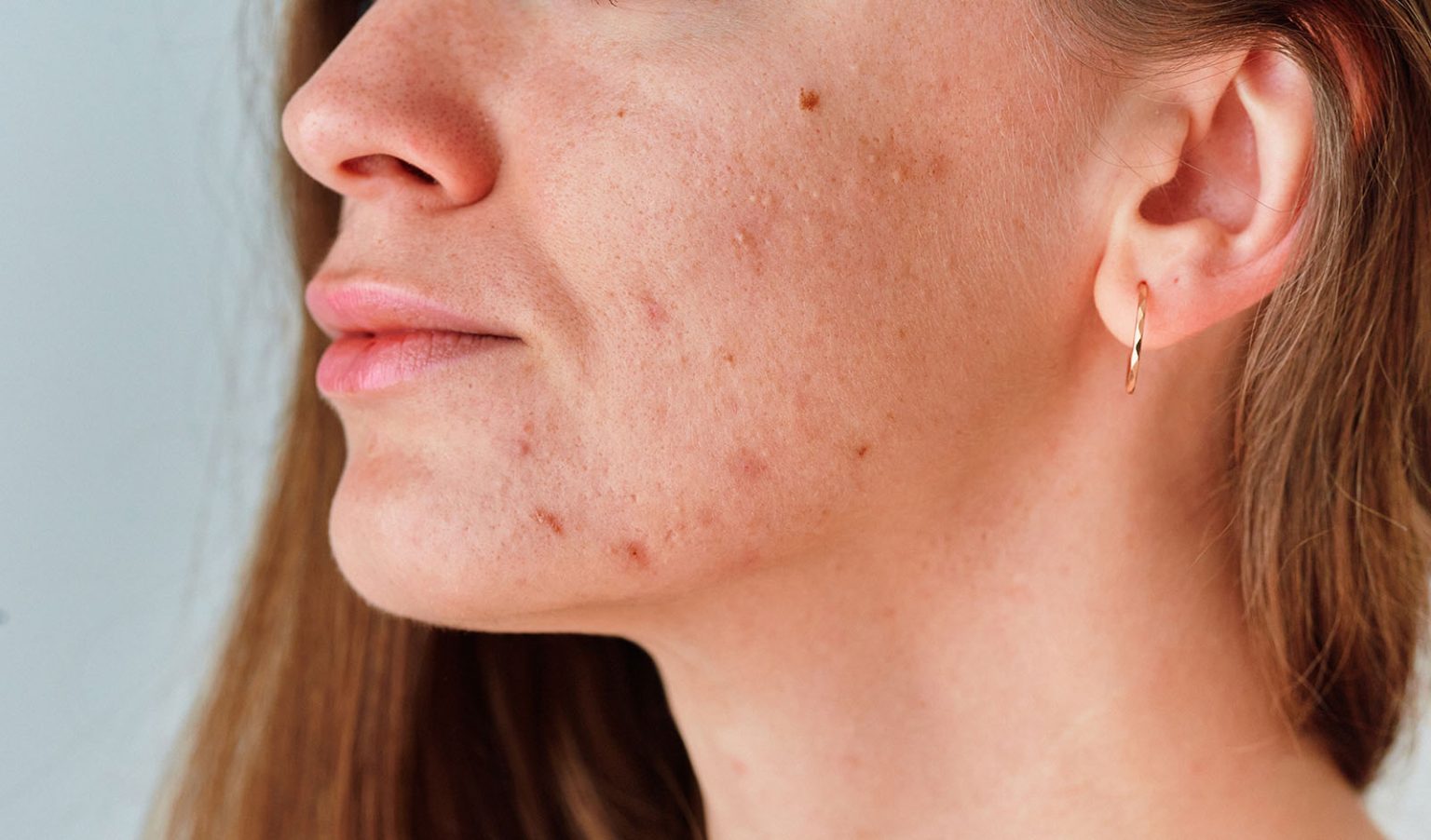 Battle Of Blemishes: Solutions For Uneven Tone And Texture - VIVA GLAM ...