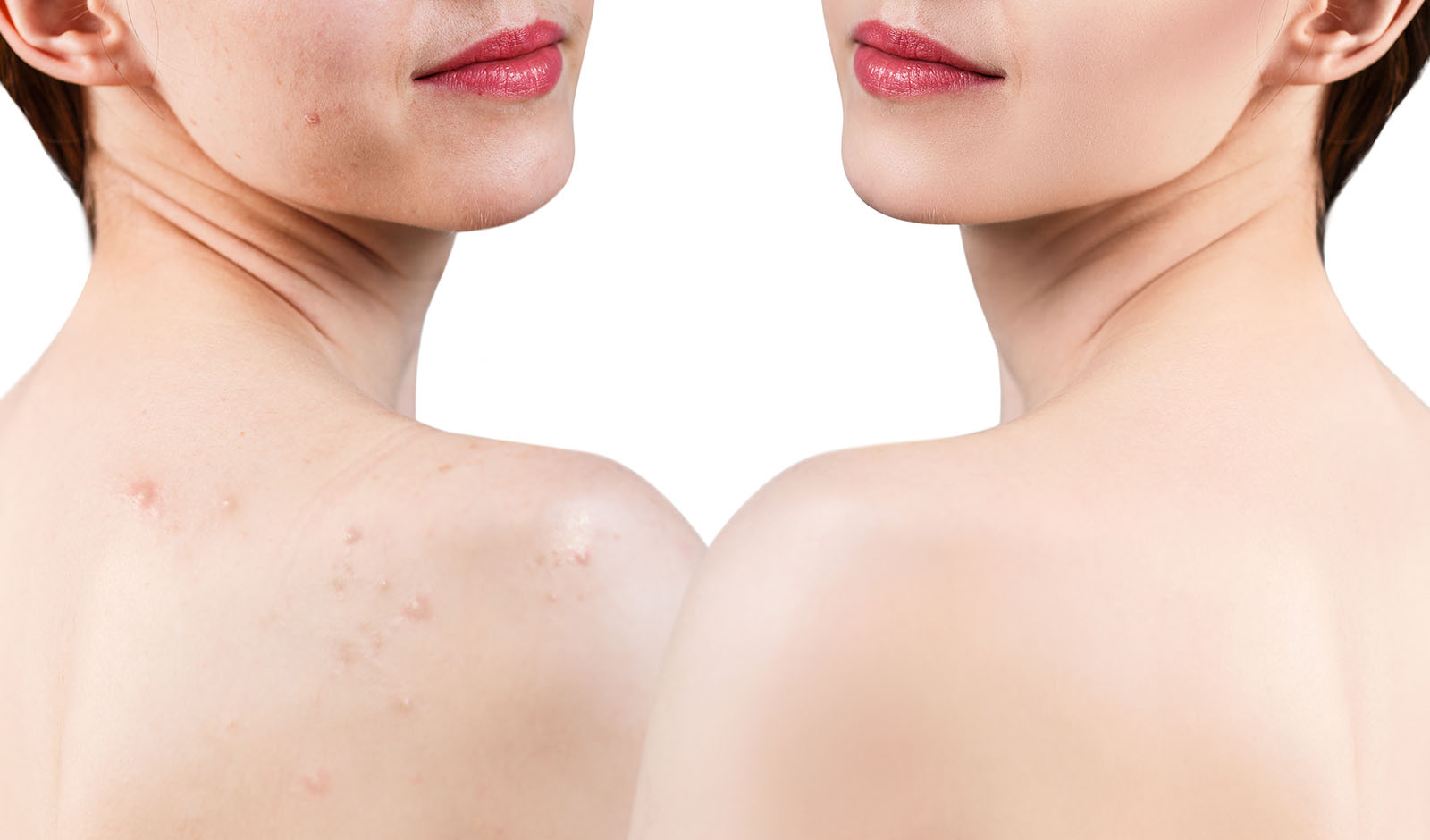 Struggling With Back Acne? Here’s What I Think Might Be Causing It ...